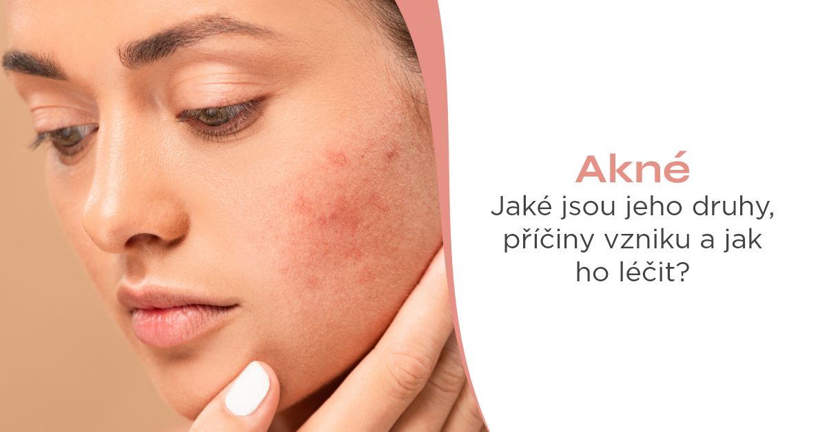Akné: jaké jsou jeho druhy, příčiny vzniku a jak ho léčit? | Curapil.cz